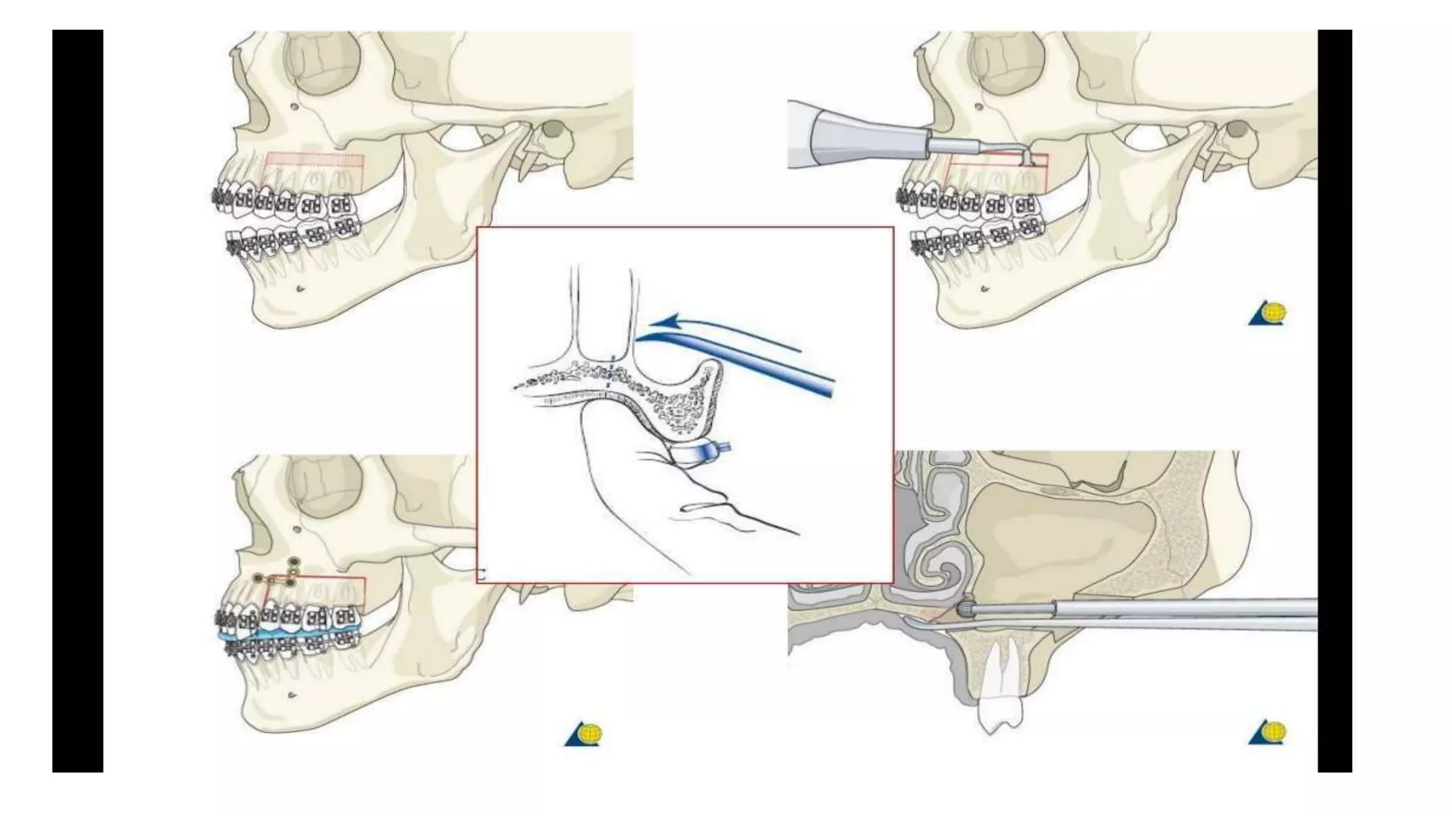 Maxillary Orthognathic Surgery | PPTX | Dental Health | Diseases and ...