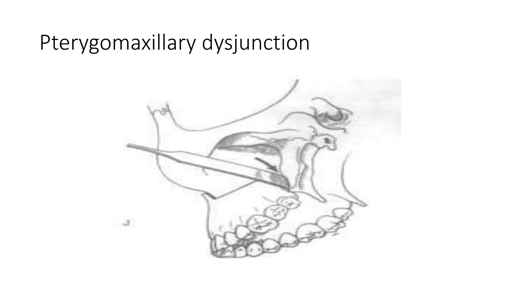 Maxillary Orthognathic Surgery | PPTX