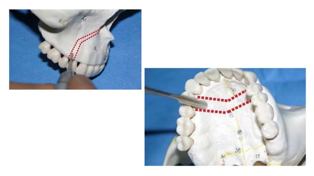 Maxillary Orthognathic Surgery | PPTX | Dental Health | Diseases and ...