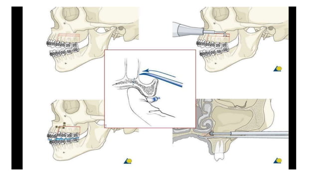 Maxillary Orthognathic Surgery | PPTX | Dental Health | Diseases and ...