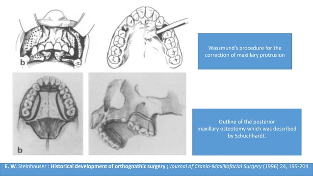 Maxillary Orthognathic Surgery | PPTX | Dental Health | Diseases and ...