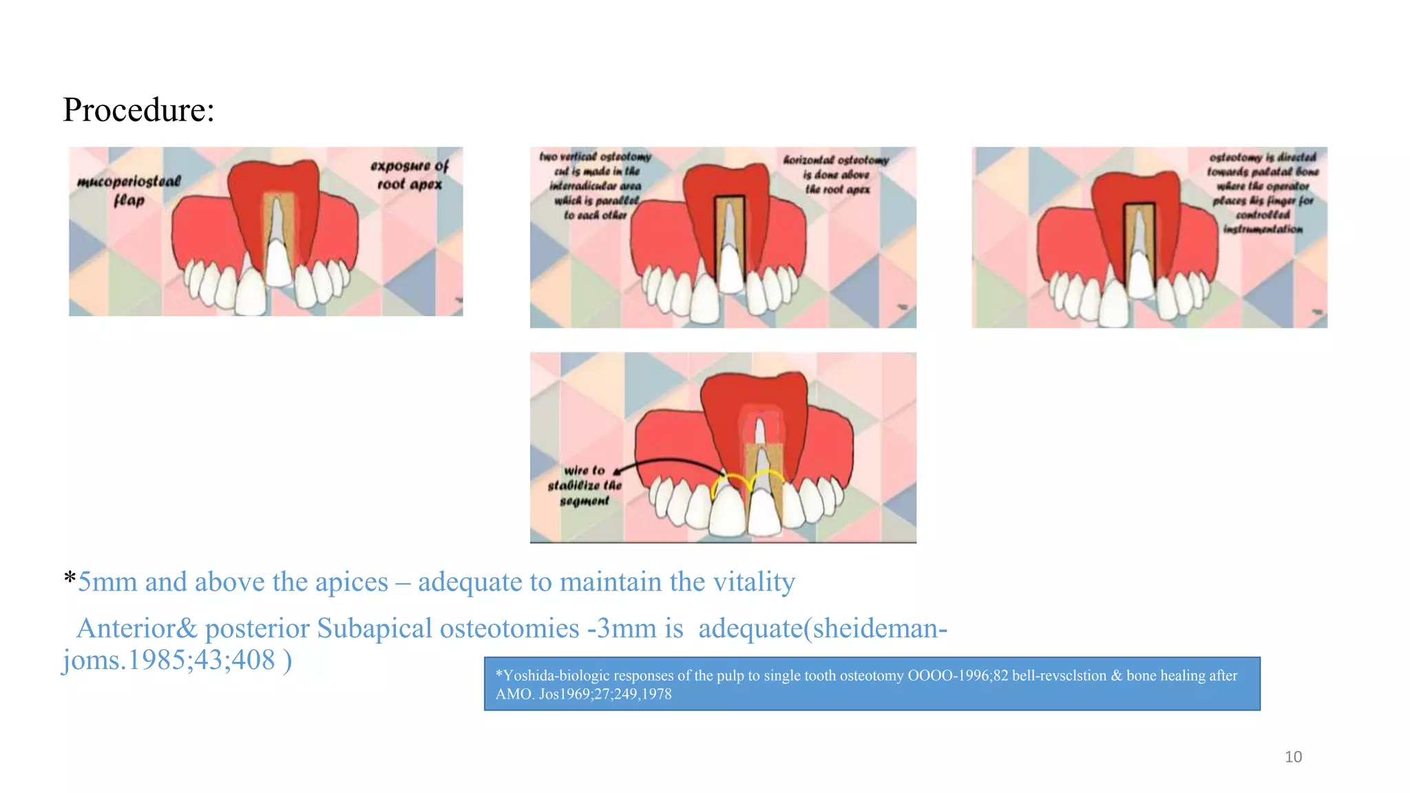 Maxillary osteotomies procedure | PPTX