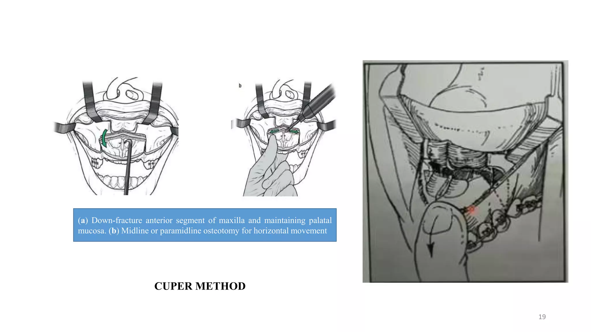 Maxillary osteotomies procedure | PPTX