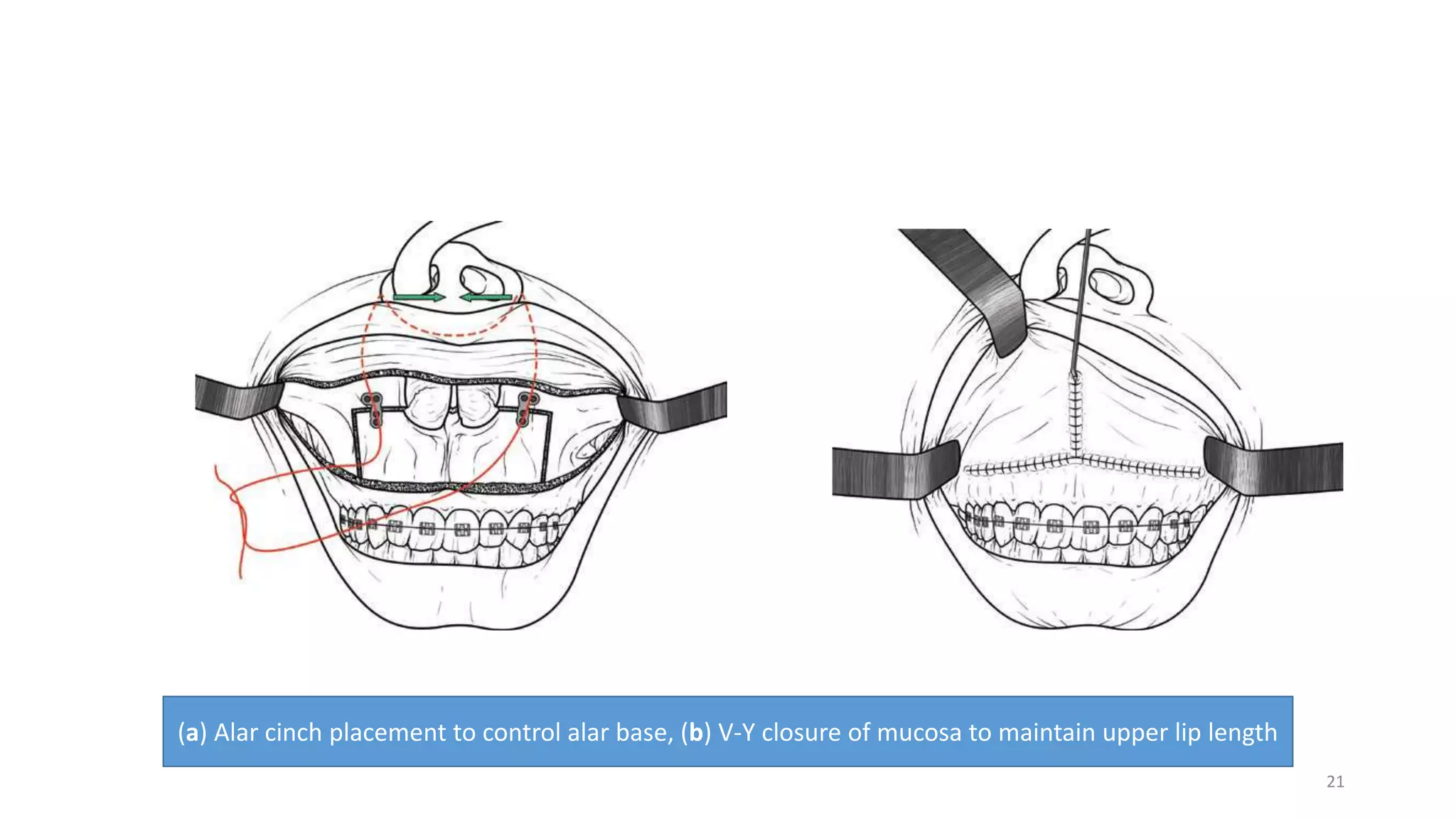 Maxillary osteotomies procedure | PPTX