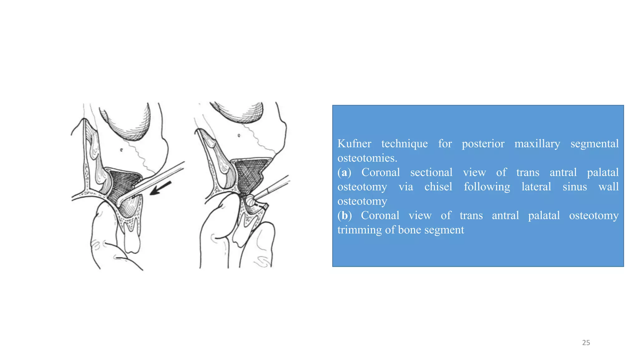 Maxillary osteotomies procedure | PPTX