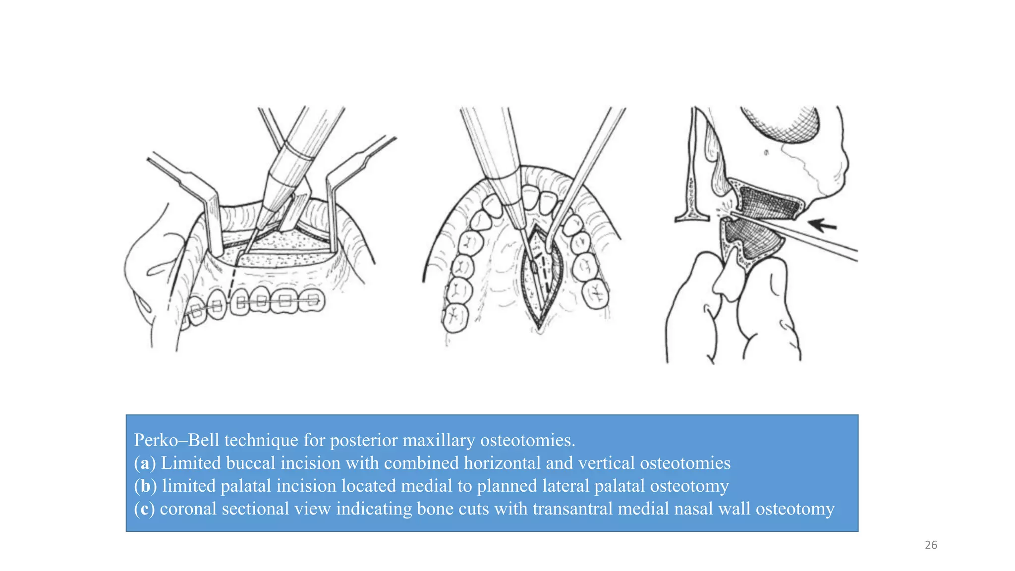 Maxillary osteotomies procedure | PPTX