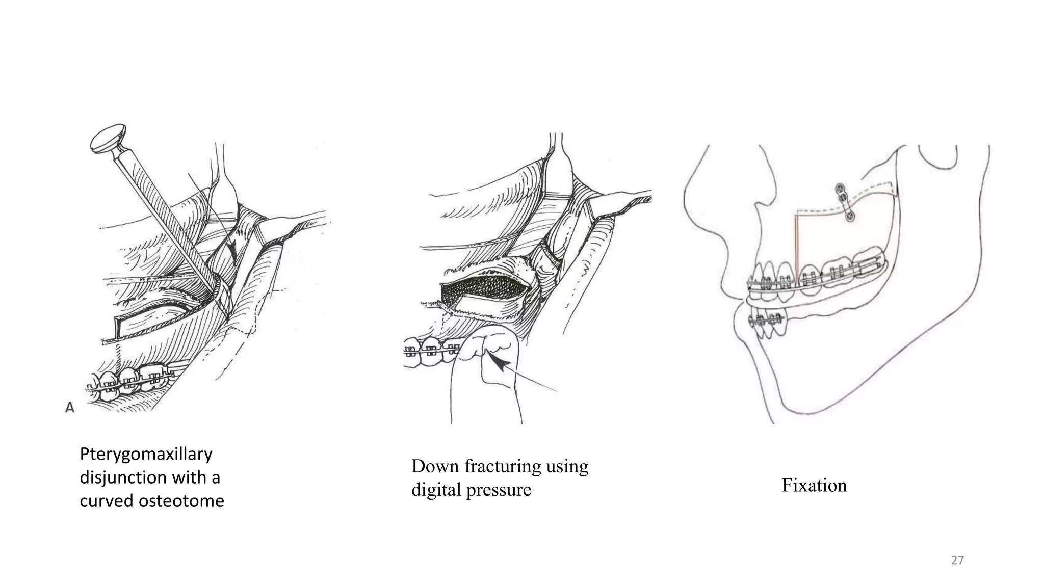 Maxillary osteotomies procedure | PPTX