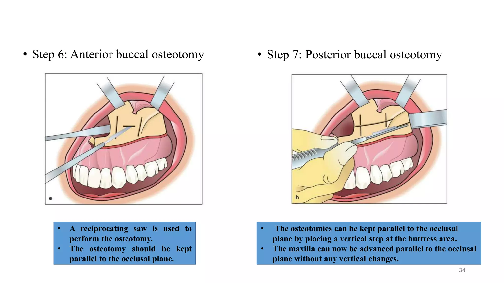 Maxillary osteotomies procedure | PPTX