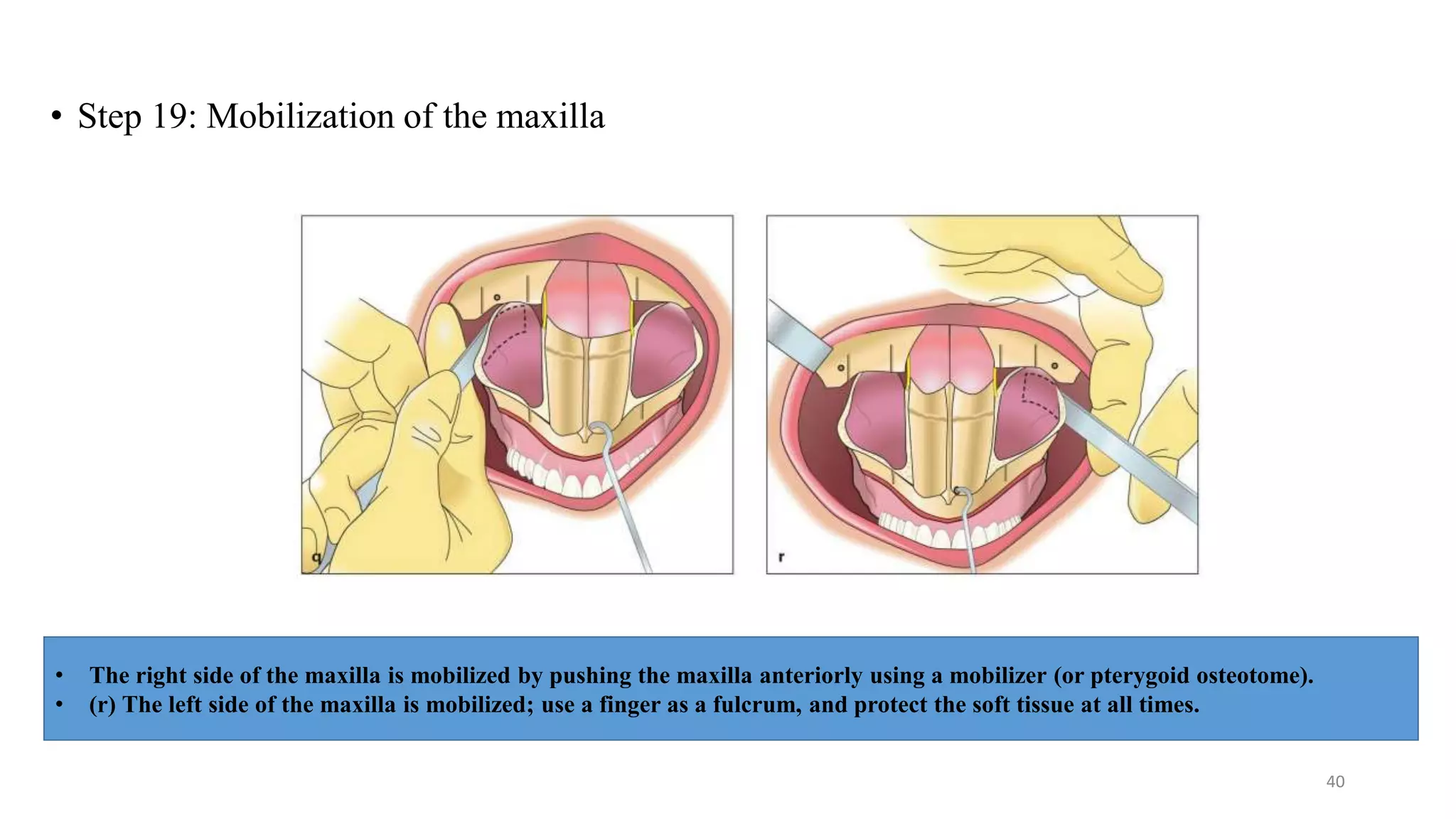 Maxillary osteotomies procedure | PPTX