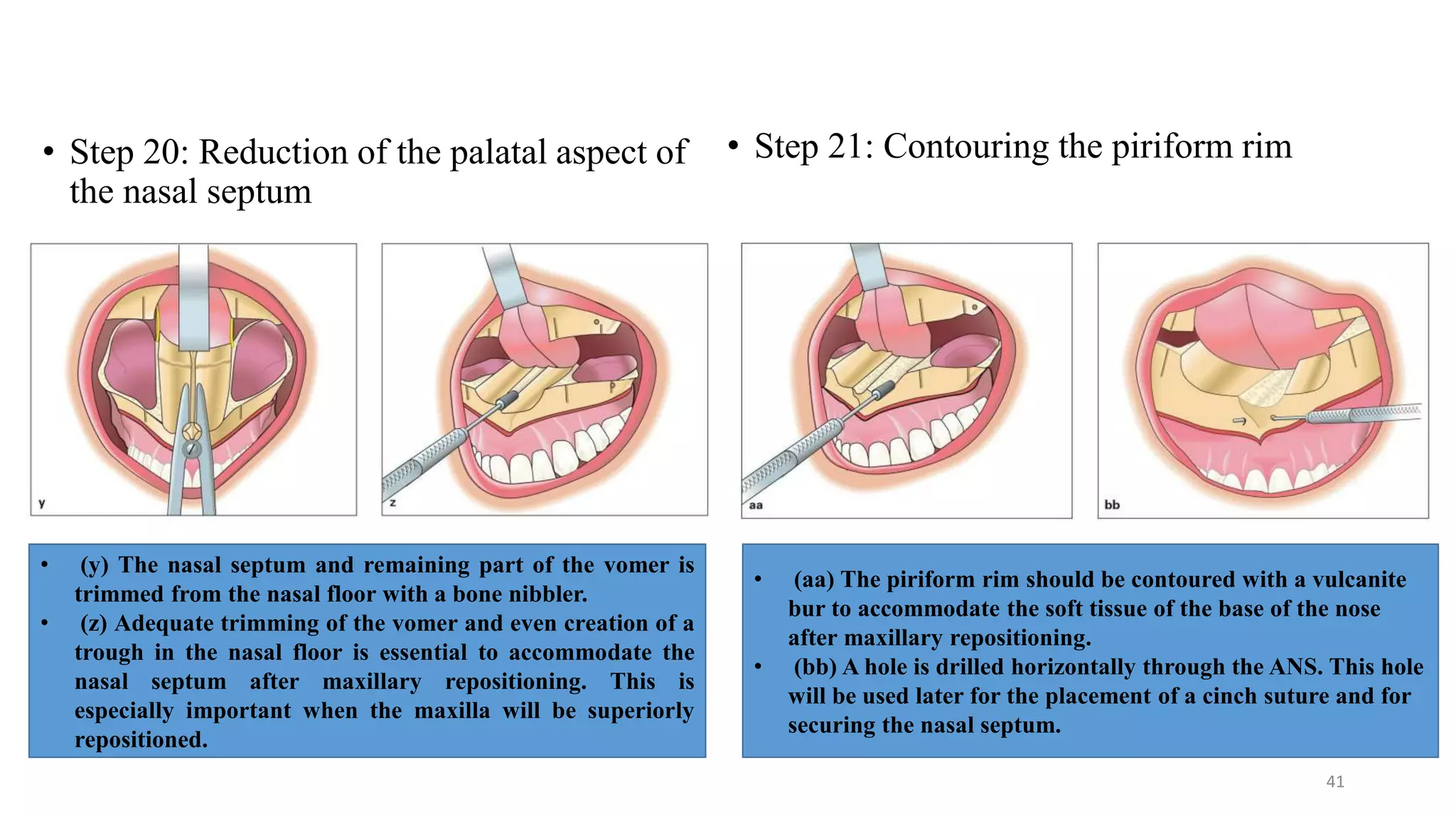 Maxillary osteotomies procedure | PPTX