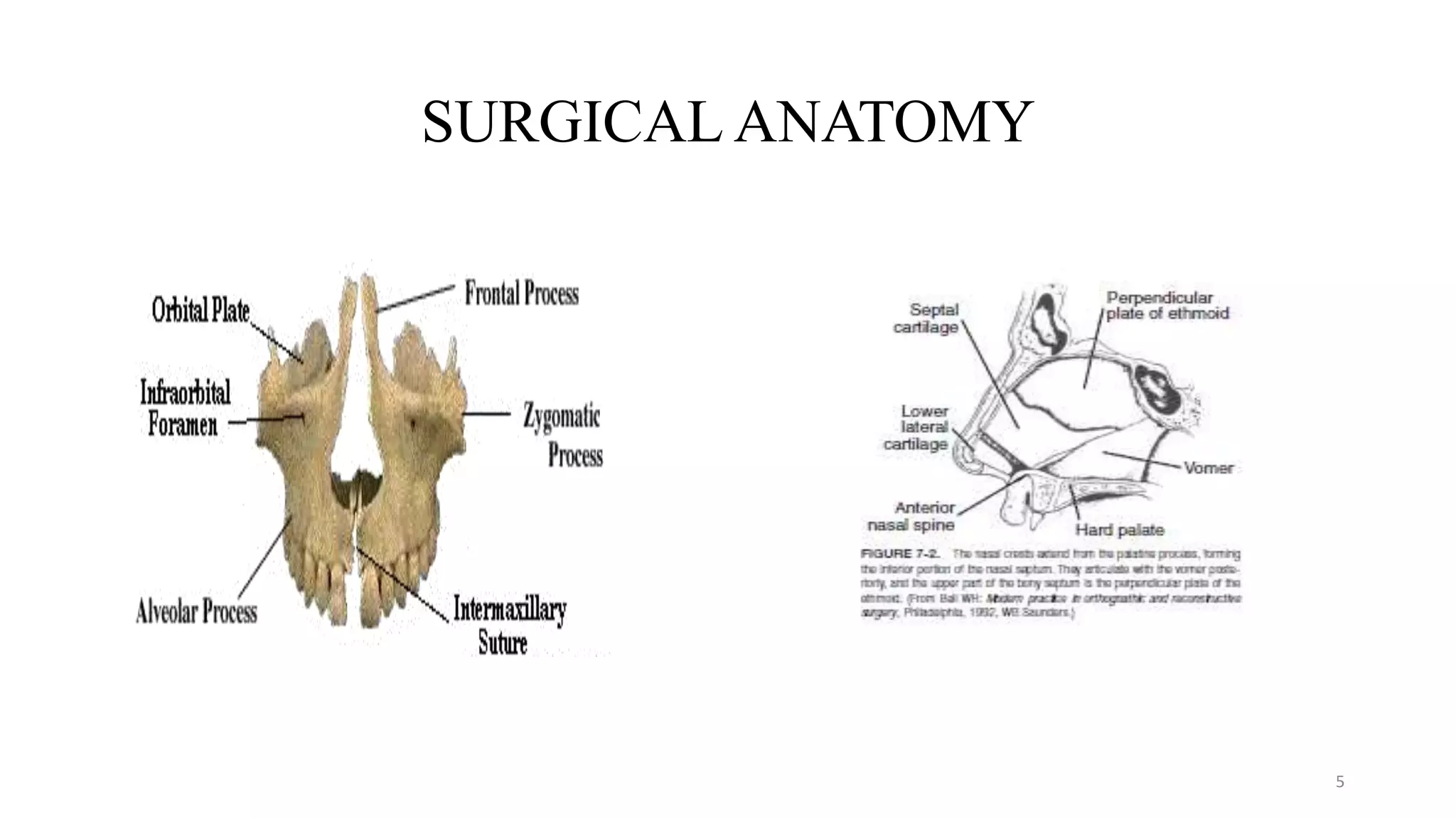 Maxillary osteotomies procedure | PPTX