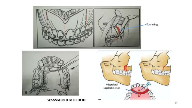 Maxillary osteotomies procedure | PPTX