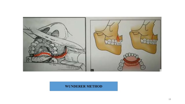 Maxillary osteotomies procedure | PPTX