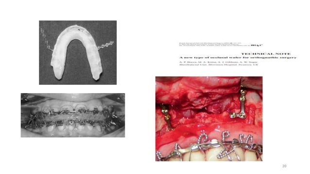 Maxillary osteotomies procedure | PPTX