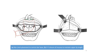Maxillary osteotomies procedure | PPTX