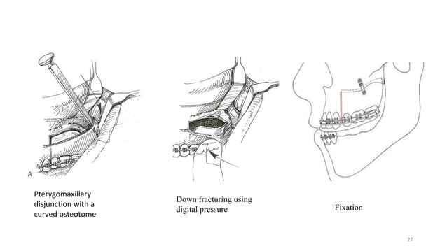 Maxillary osteotomies procedure | PPTX