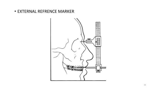 Maxillary osteotomies procedure | PPTX