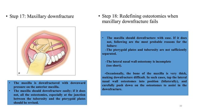 Maxillary osteotomies procedure | PPTX