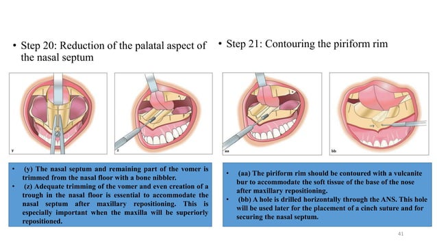 Maxillary osteotomies procedure | PPTX