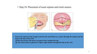 Maxillary osteotomies procedure | PPTX