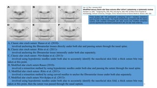 Maxillary osteotomies procedure | PPTX