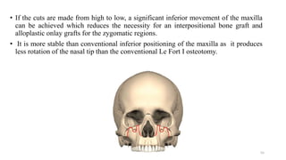 Maxillary osteotomies procedure | PPTX