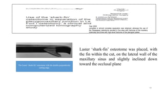 Maxillary osteotomies procedure | PPTX