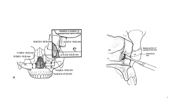 Maxillary osteotomies procedure | PPTX