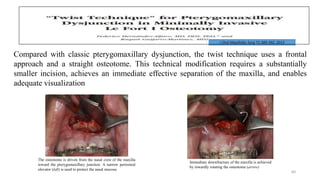 Maxillary osteotomies procedure | PPTX