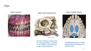 Maxillary osteotomies procedure | PPTX