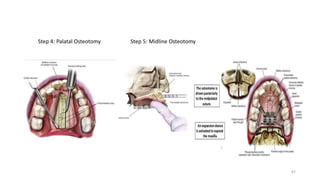 Maxillary osteotomies procedure | PPTX