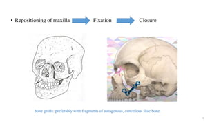Maxillary osteotomies procedure | PPTX