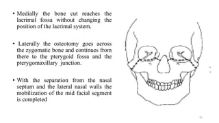 Maxillary osteotomies procedure | PPTX