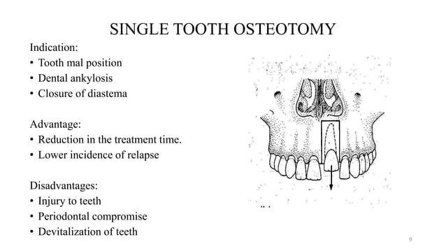 Maxillary osteotomies procedure | PPTX