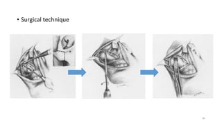 Maxillary osteotomies procedure | PPTX