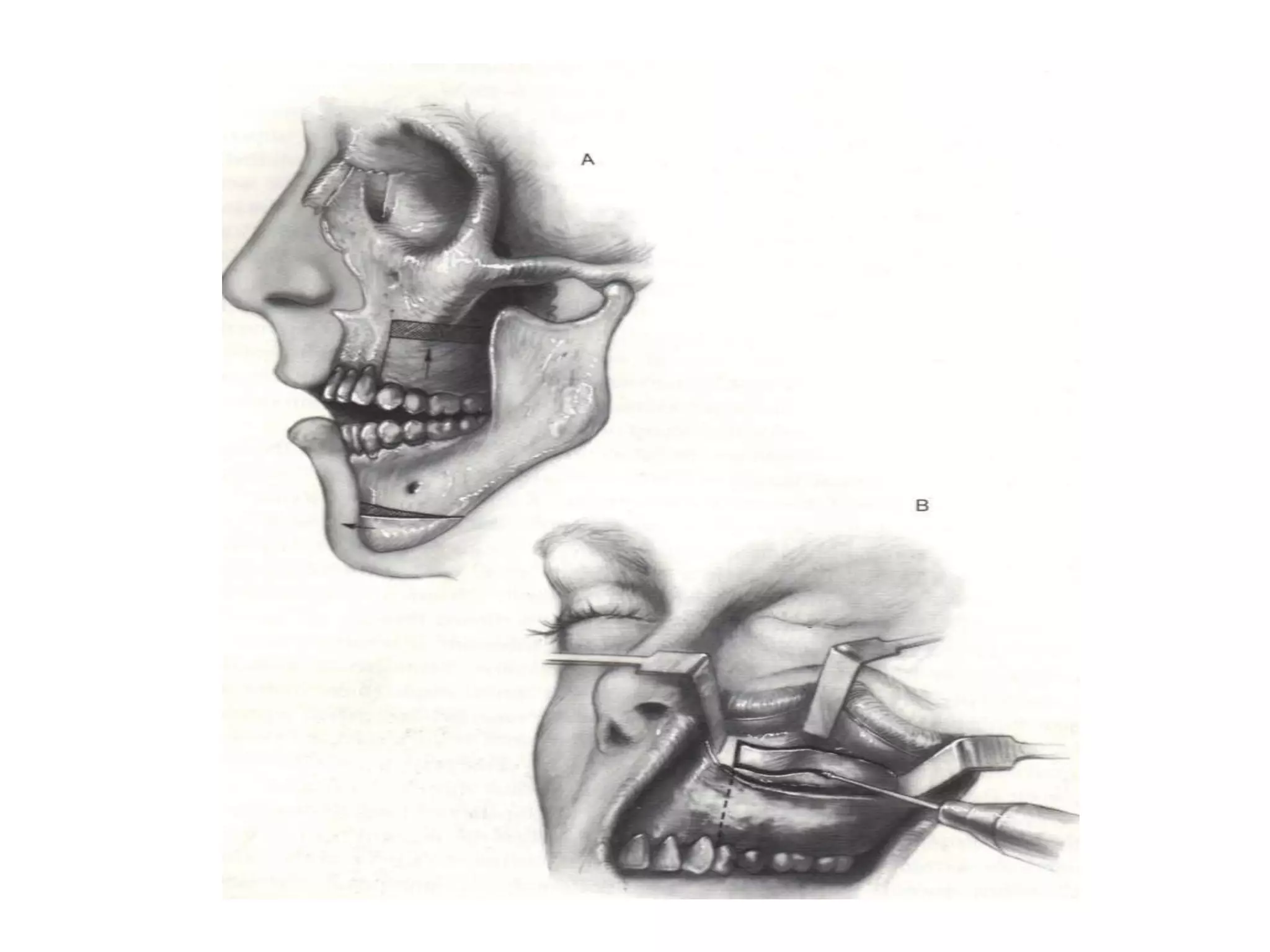 Maxillary Osteotomies & Associated Surgical complications | PPTX | Bone ...