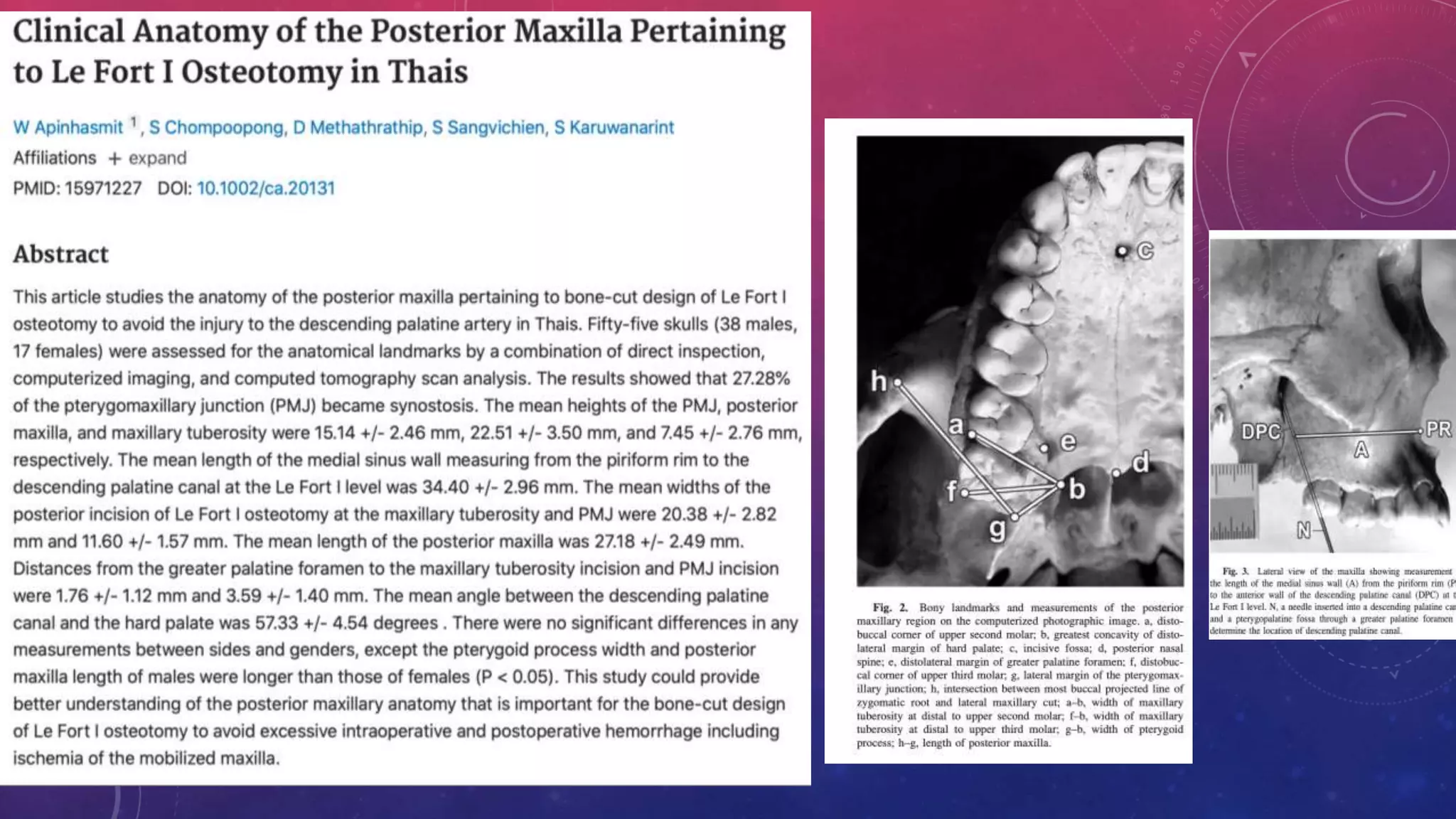 Maxillary osteotomy | PPTX