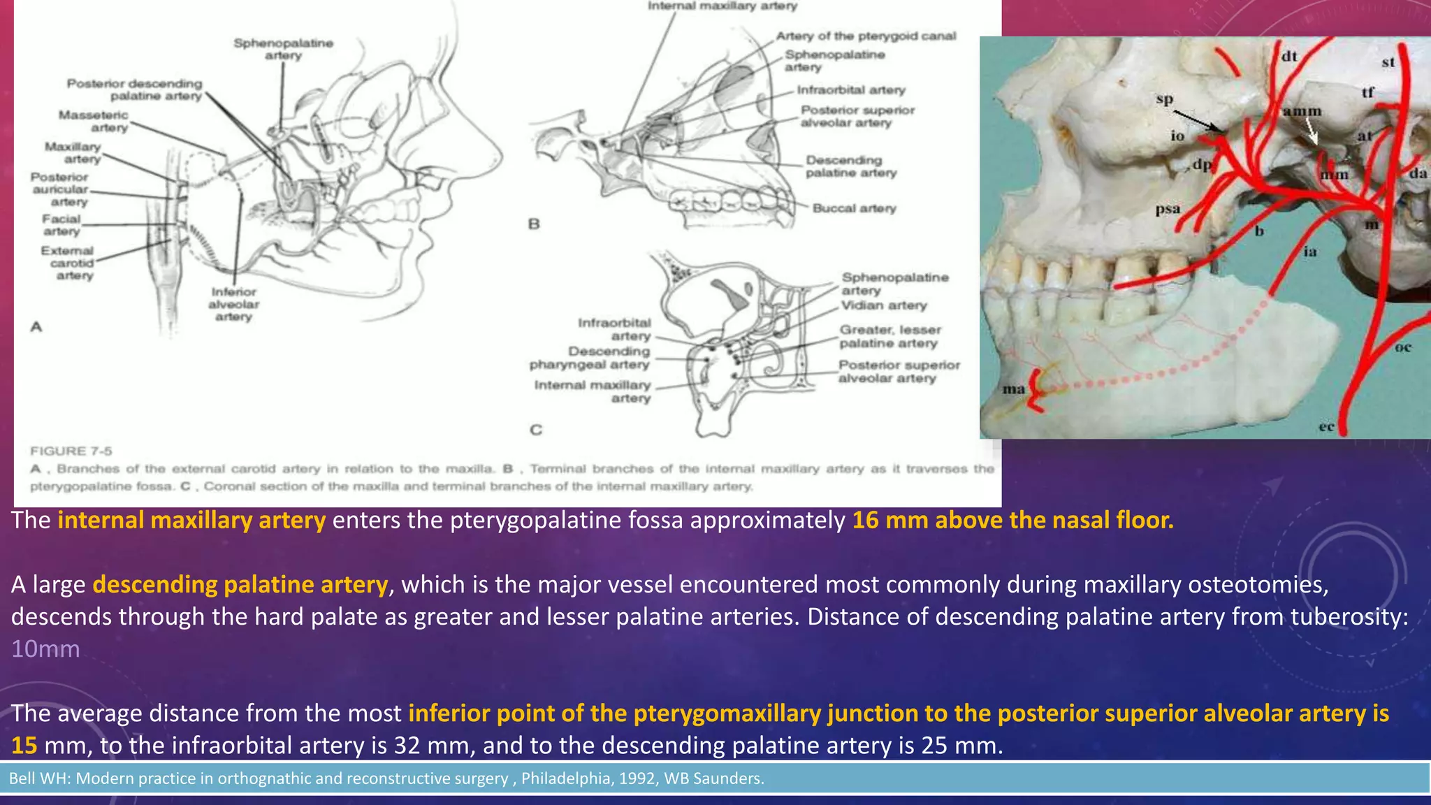 Maxillary osteotomy | PPTX