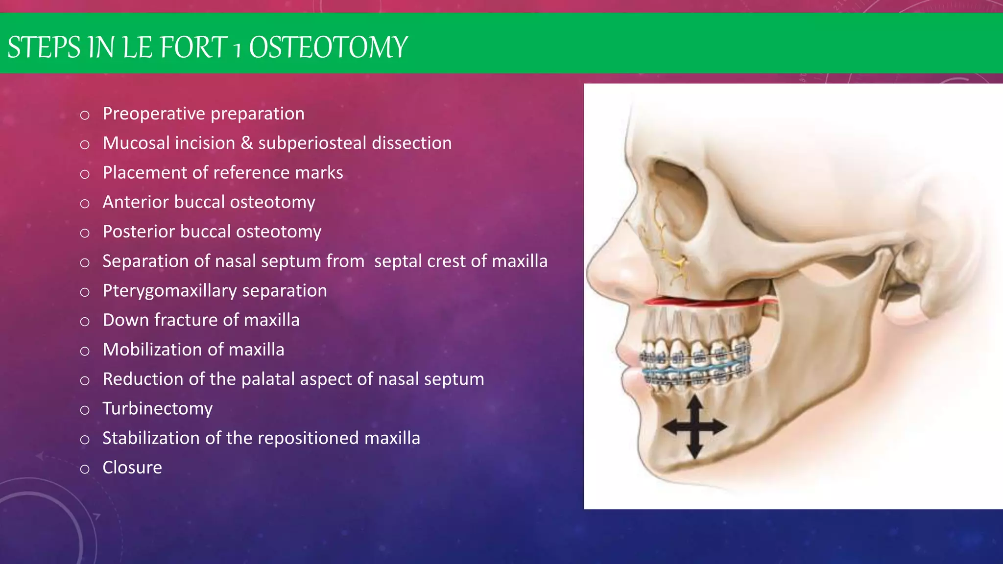 Maxillary osteotomy | PPTX