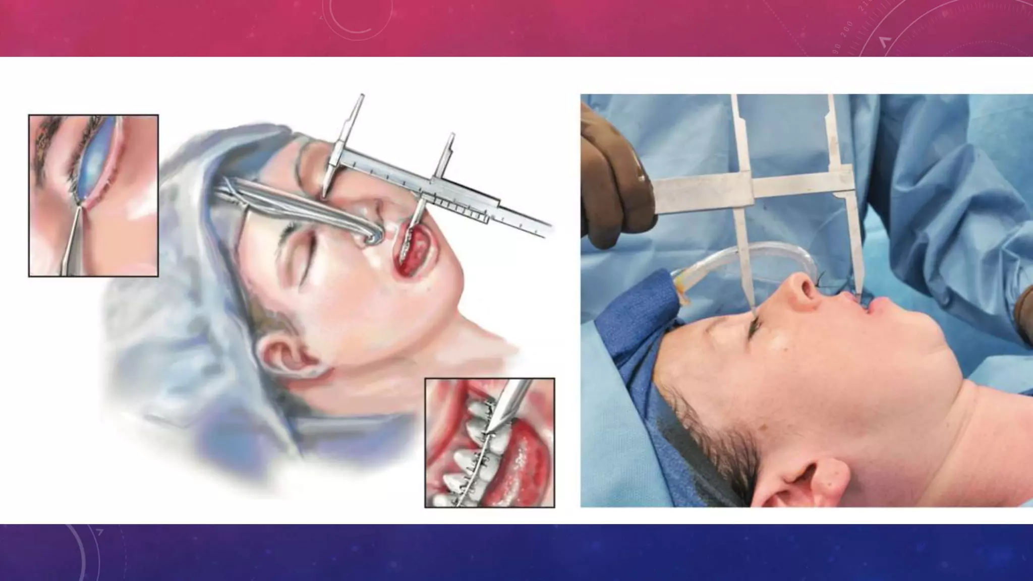 Maxillary osteotomy | PPTX