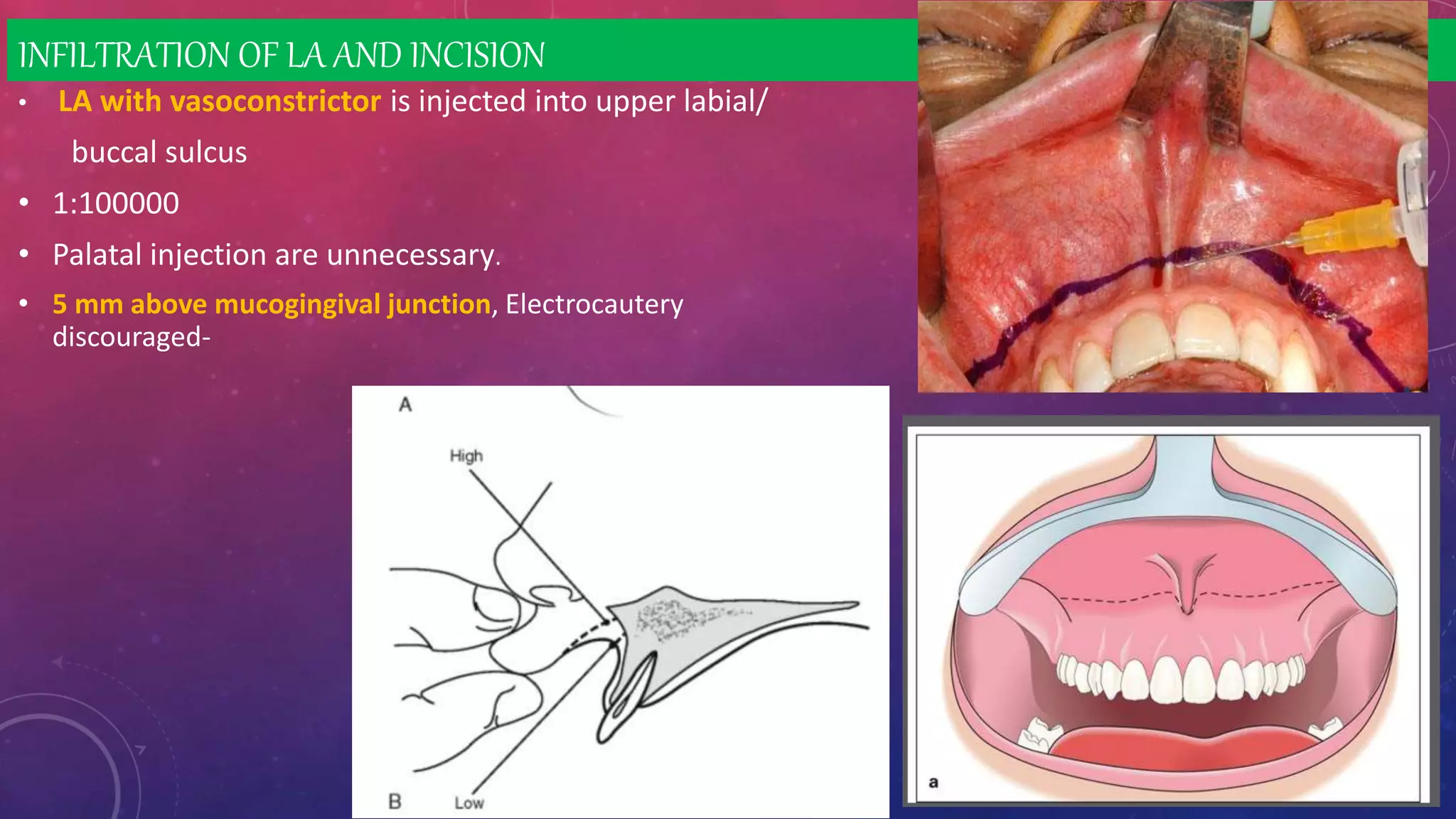 Maxillary osteotomy | PPTX