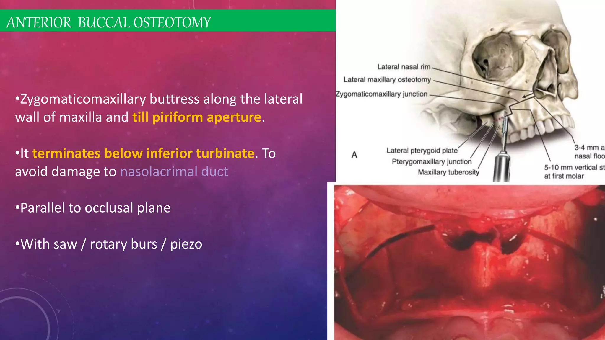 Maxillary osteotomy | PPTX