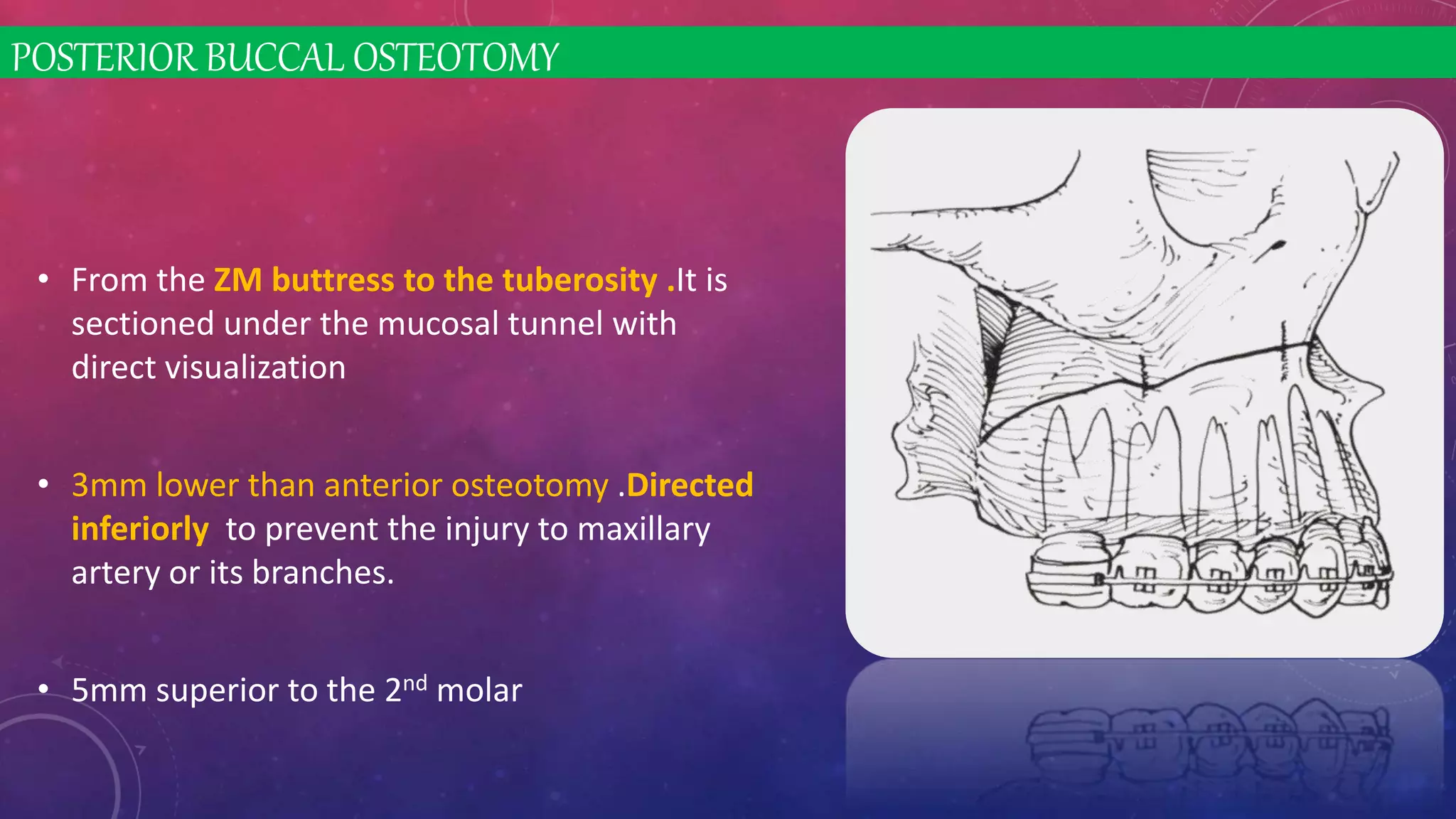 Maxillary osteotomy | PPTX