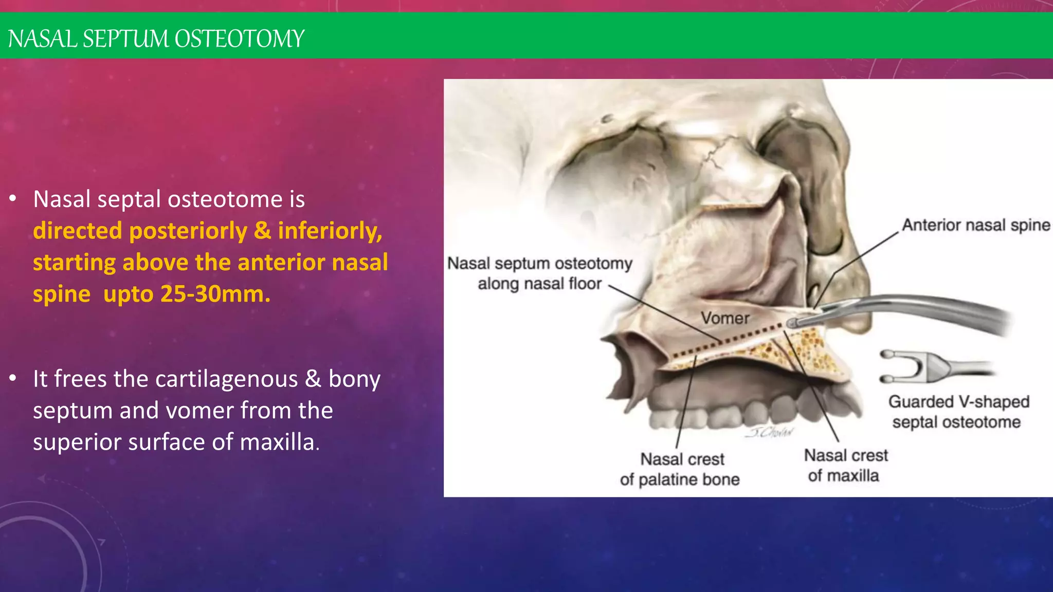 Maxillary osteotomy | PPTX