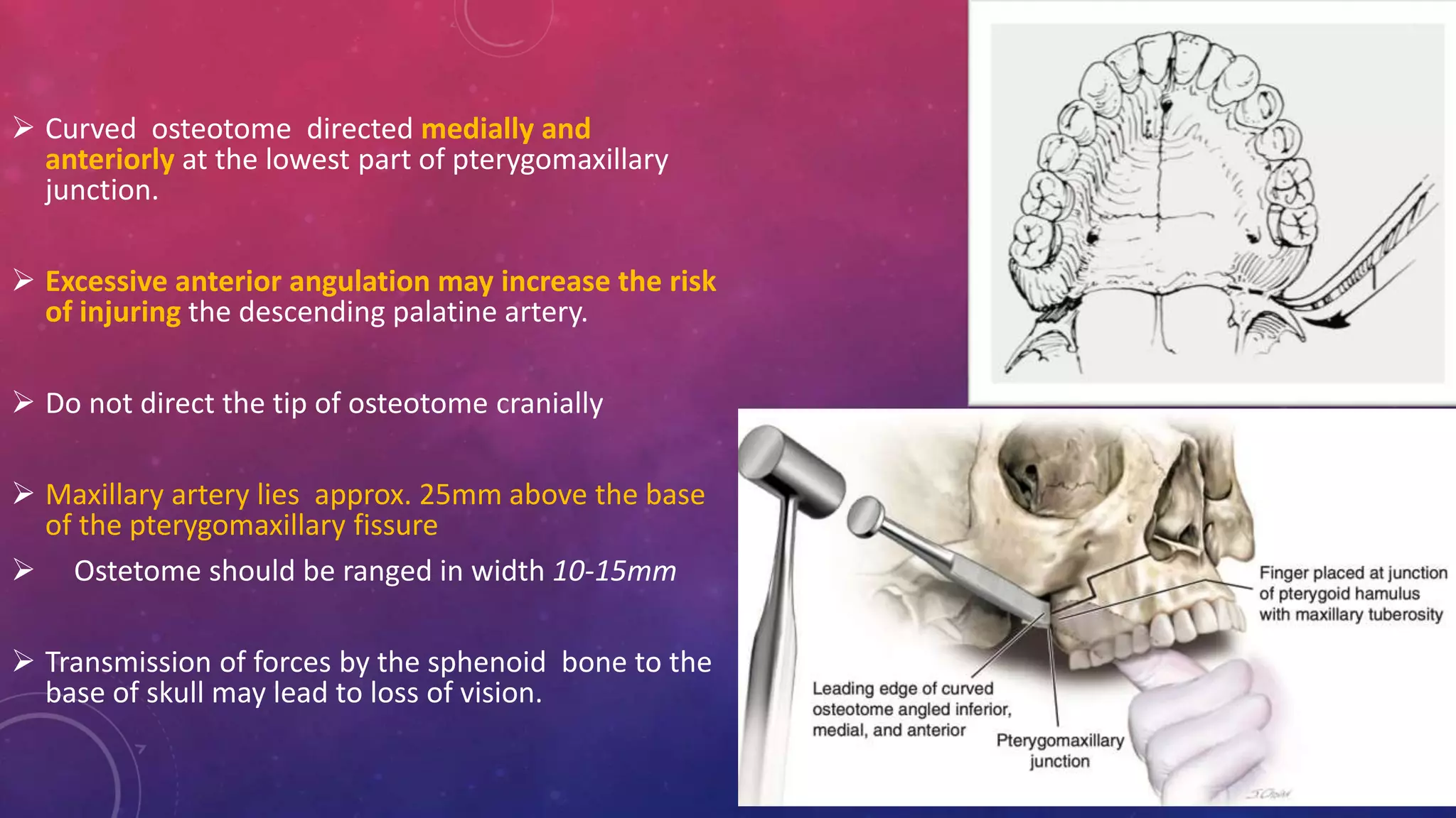 Maxillary osteotomy | PPTX