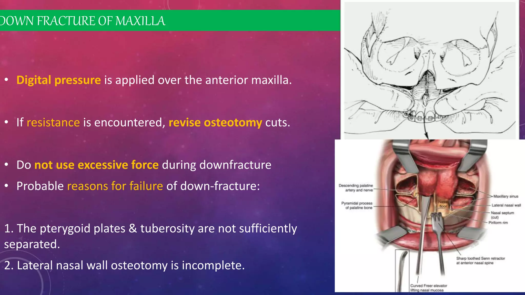 Maxillary osteotomy | PPTX