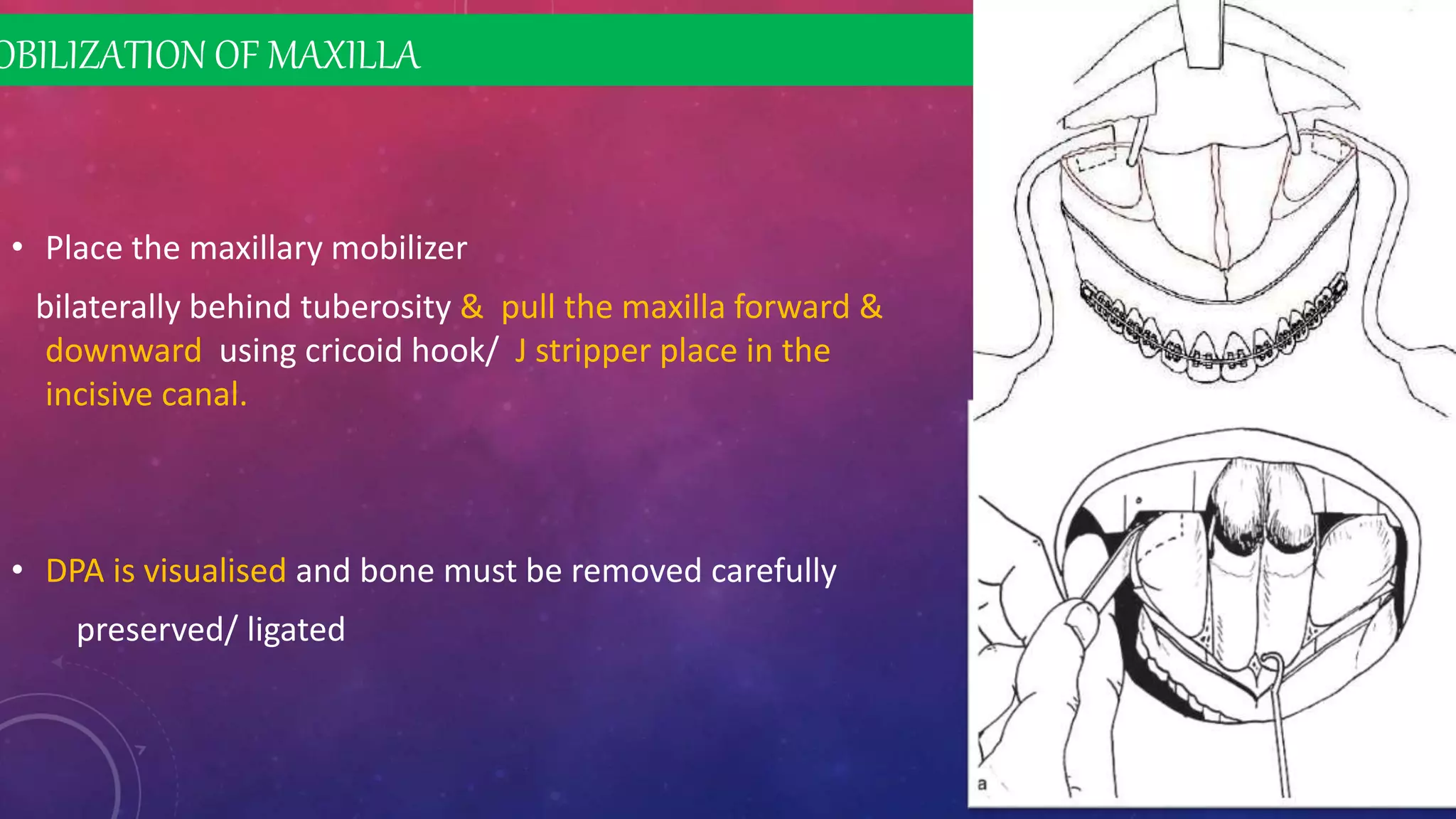 Maxillary osteotomy | PPTX
