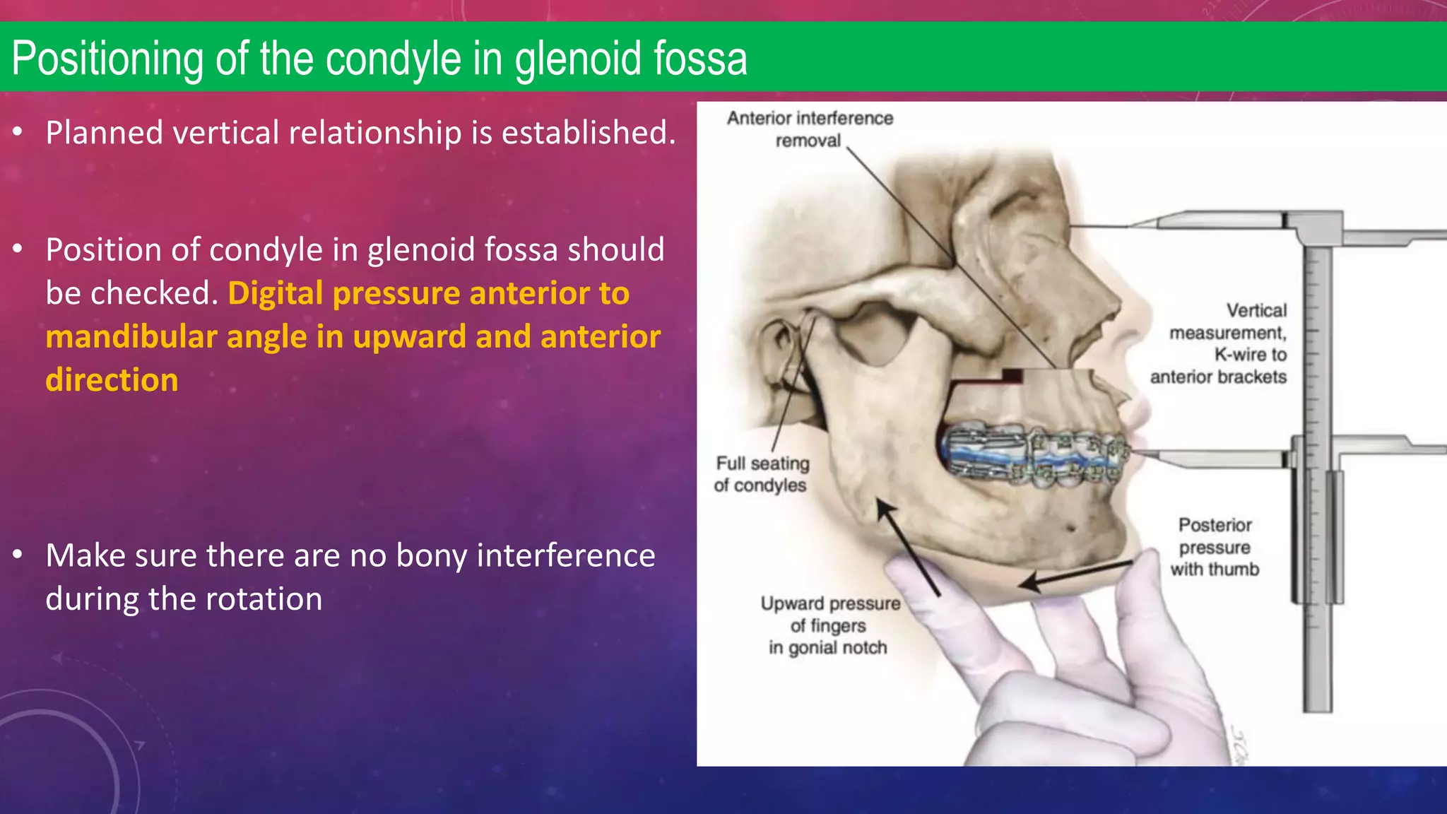 Maxillary osteotomy | PPTX