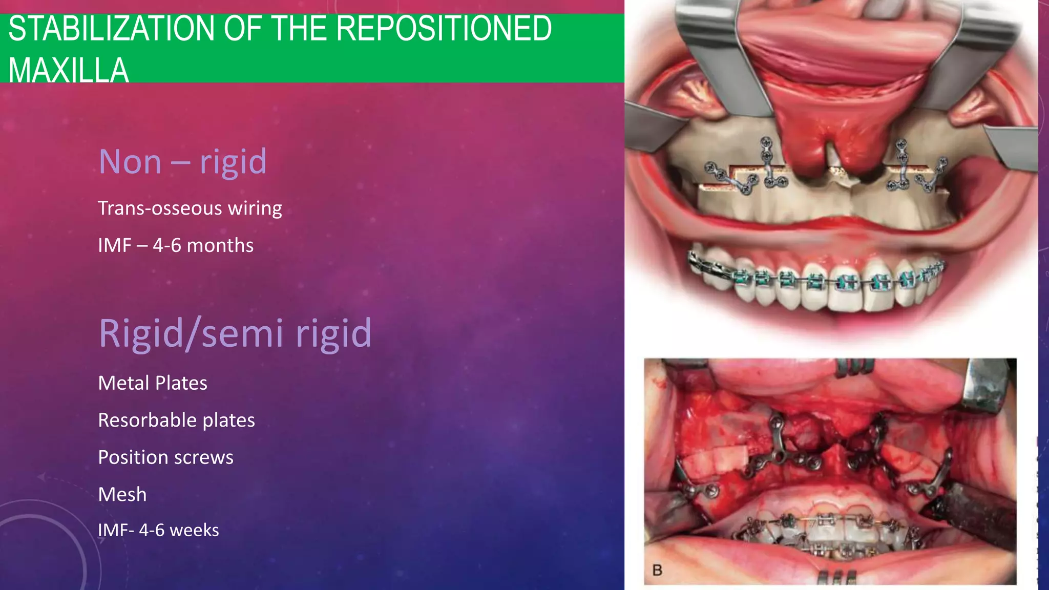 Maxillary osteotomy | PPTX