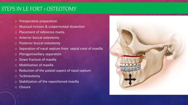 Maxillary osteotomy | PPTX